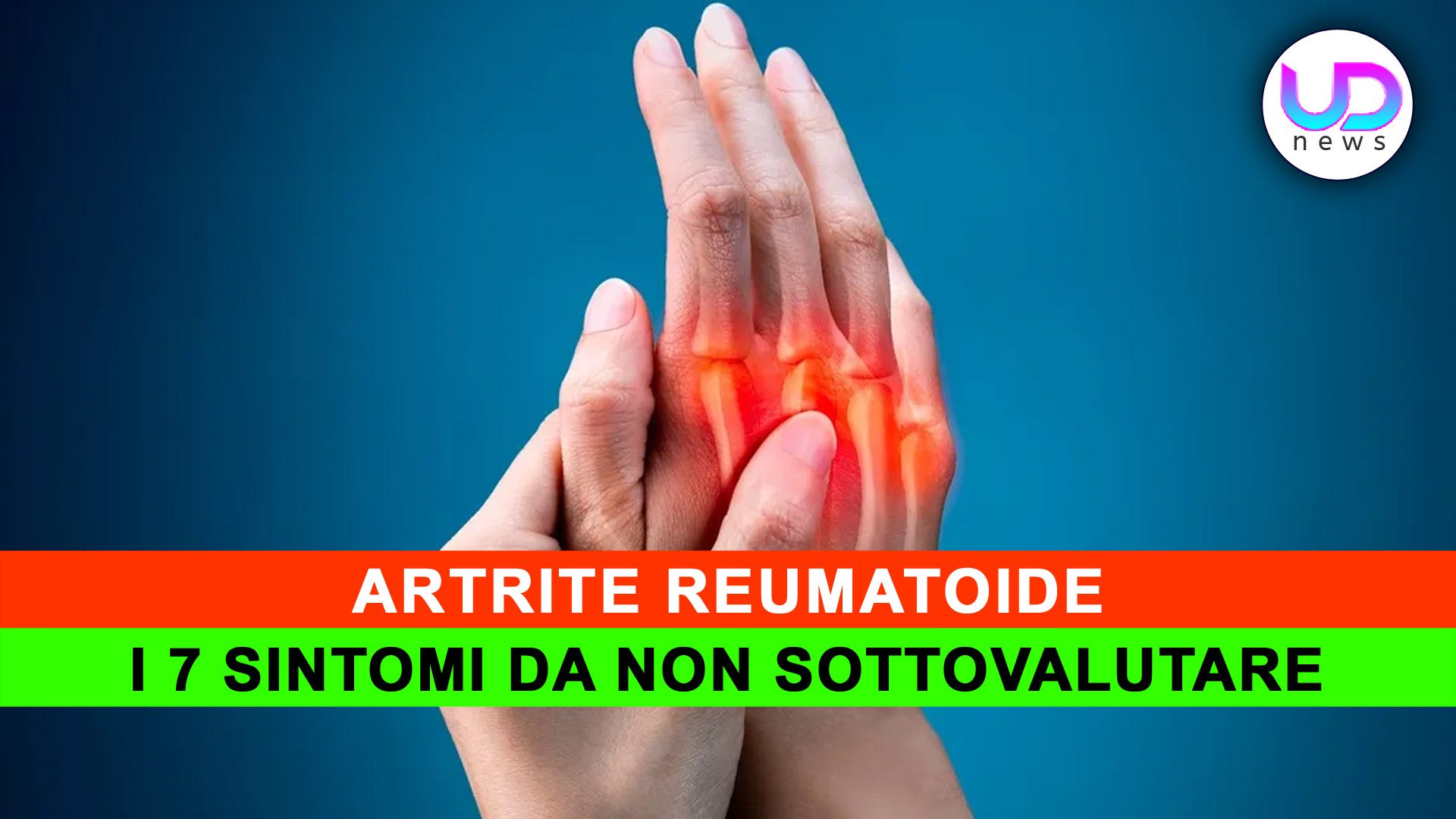 Artrite Reumatoide: I 7 Sintomi Da Non Sottovalutare!