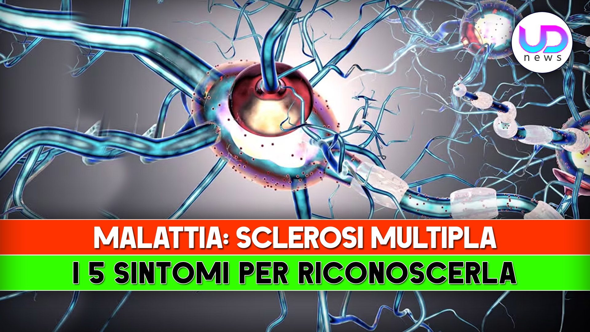 Malattia Autoimmune, Sclerosi Multipla: i 5 Sintomi Per Riconoscerla!