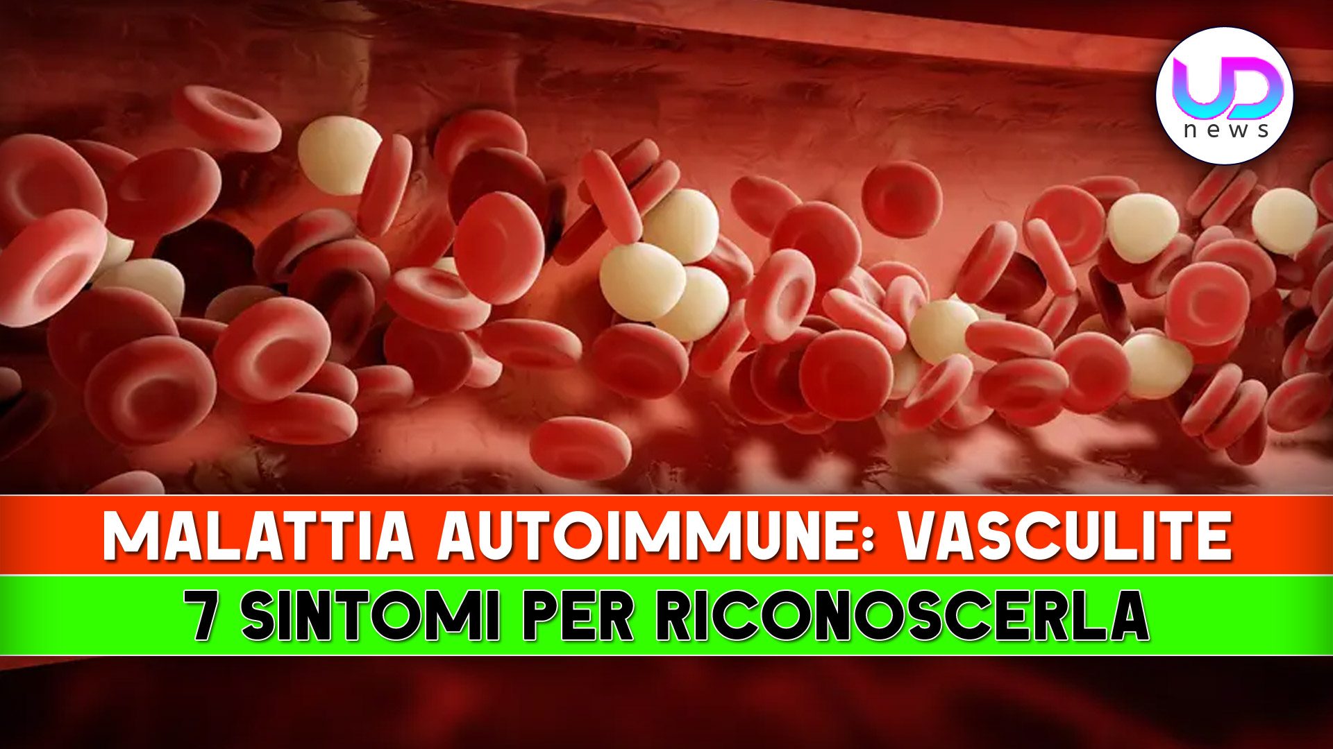 Malattia Autoimmune, Vasculite: I 7 Sintomi Per Riconoscerla!
